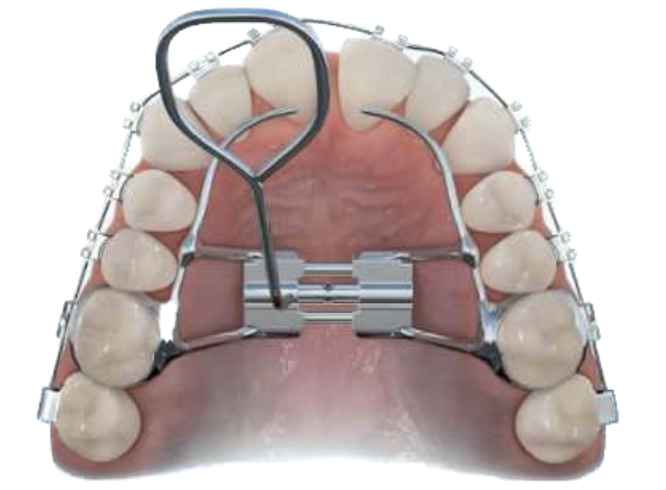 MSE Palate Expander: Face Changes, Before & After